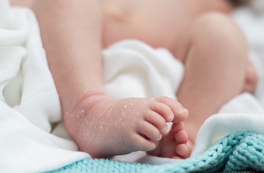Dry Skin in Babies & Children: Causes & Remedies