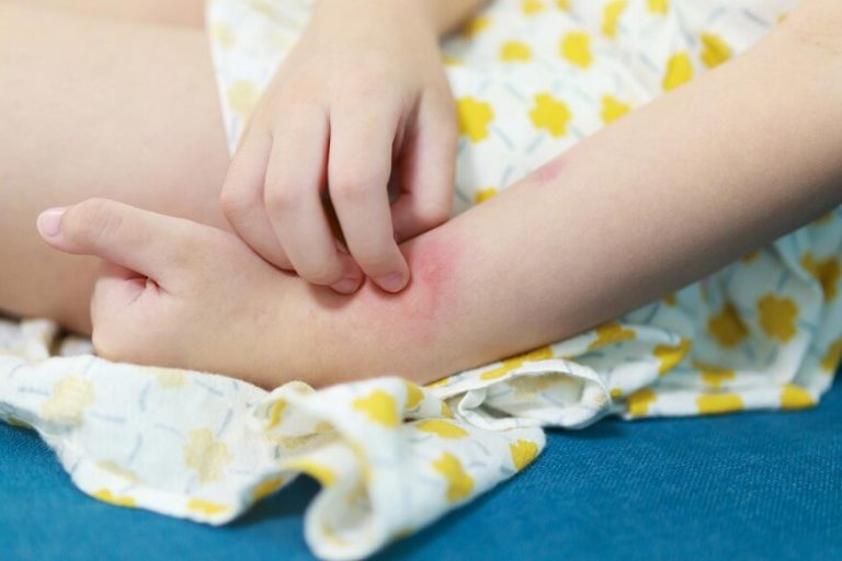 Understanding and Managing Heat Rash in Kids: Causes & Prevention