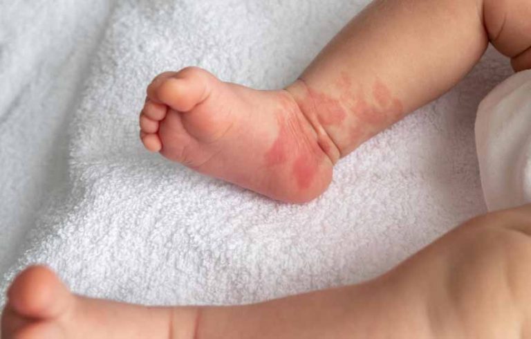 Understanding Baby Birthmarks: Types, Causes, and Lifespan Explained